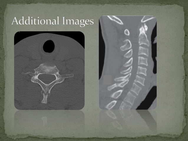 Clay Shoveler's Fracture | PPTX