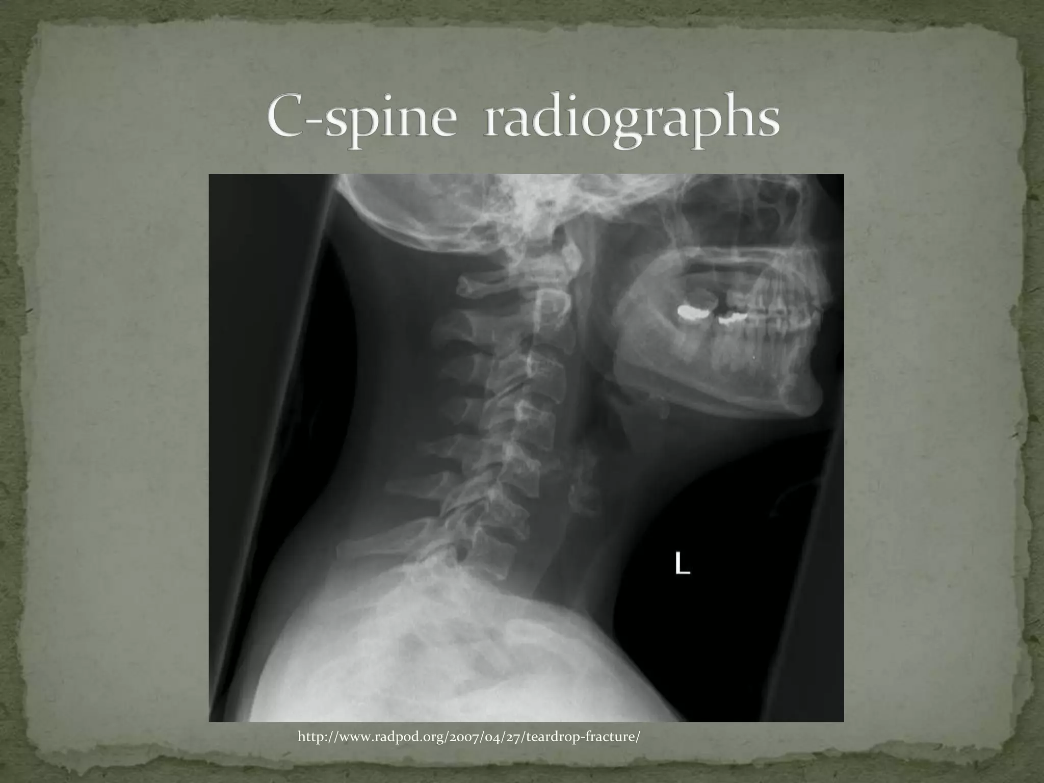 Spine Flexion Teardrop Fracture | PPTX