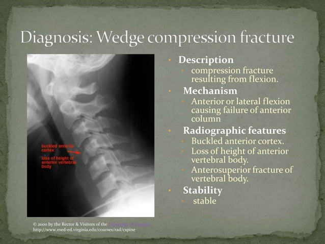 Wedge Compression Fracture Ppt