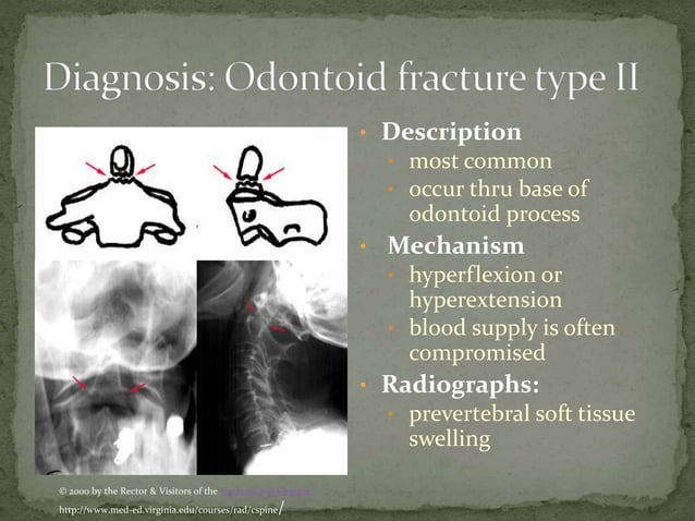 Spine4.odontoid | PPT