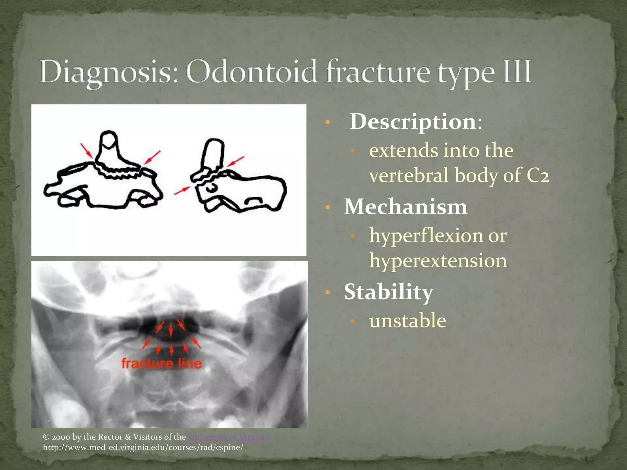 Odontoid Fractures | PPTX