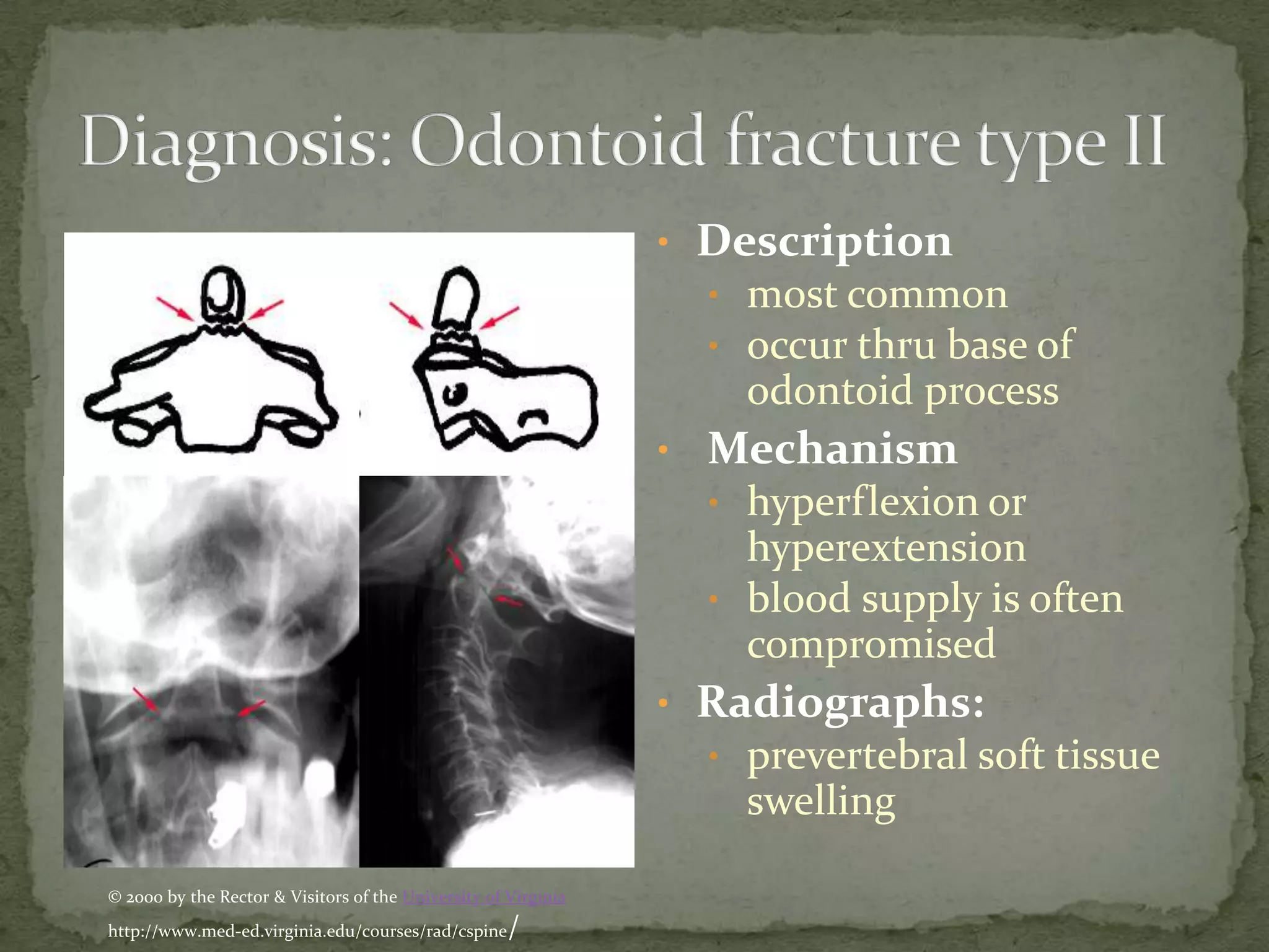 Odontoid Fractures | PPTX