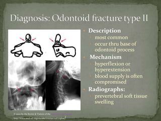 Odontoid Fracture