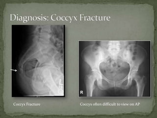 Coccyx Fracture | PPTX