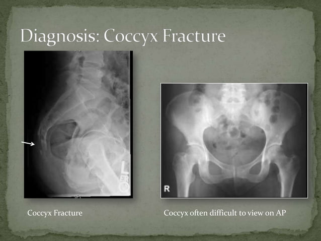 Coccyx Fracture | PPTX