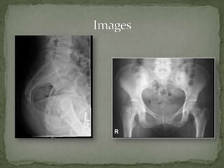 Coccyx Bone Fracture