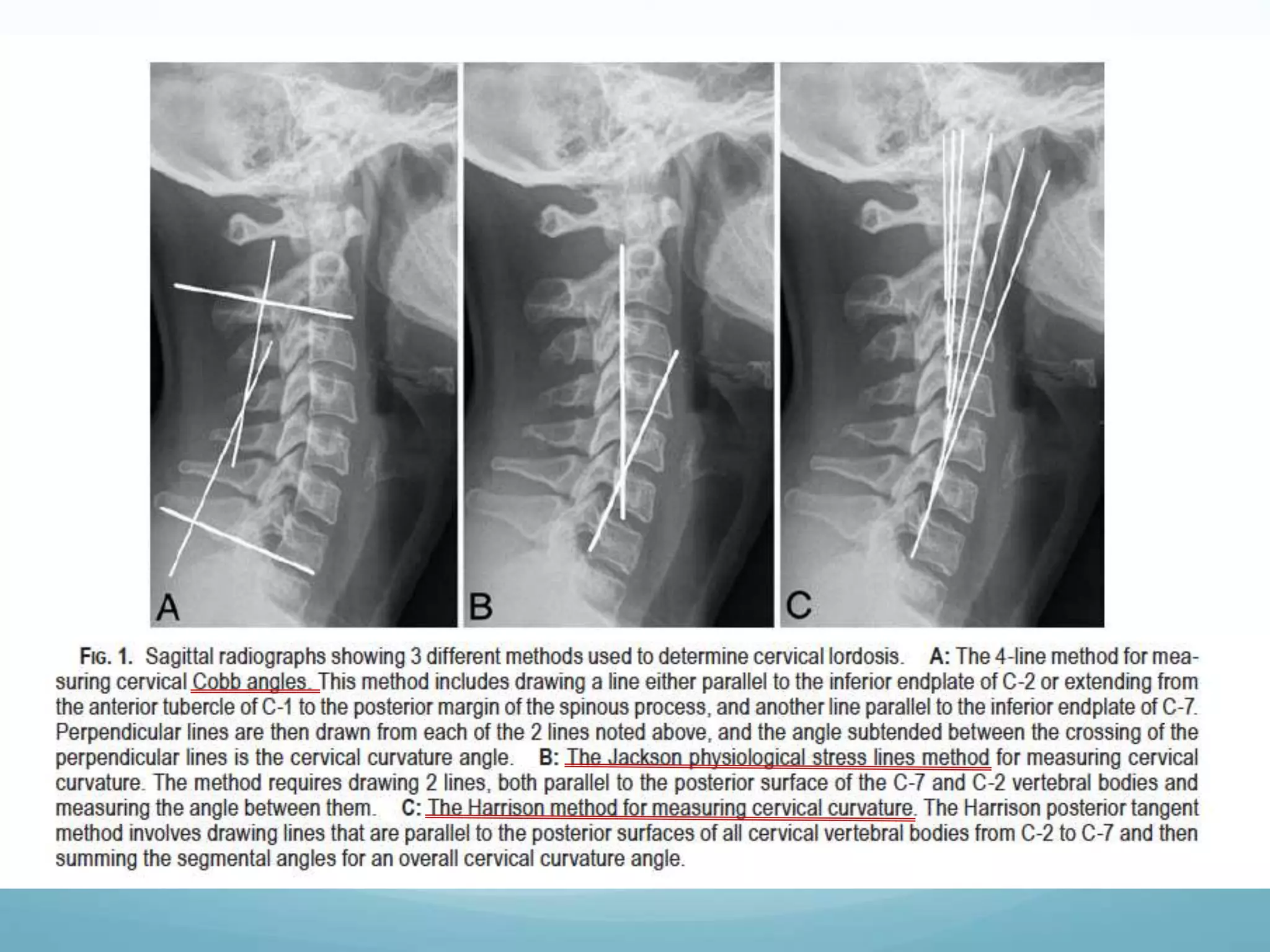 Evaluation of Spinal alignment | PPT