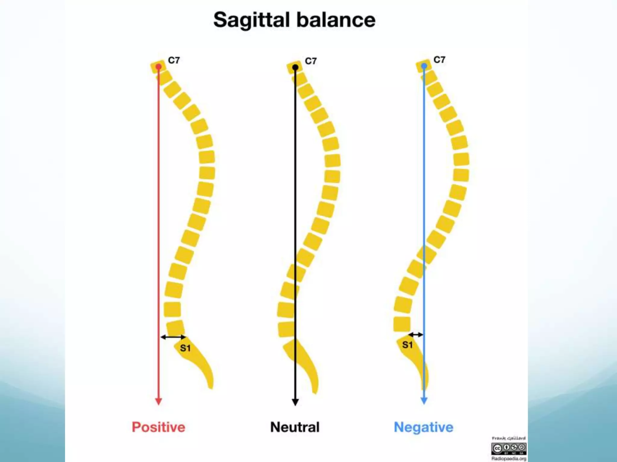 Evaluation of Spinal alignment | PPT
