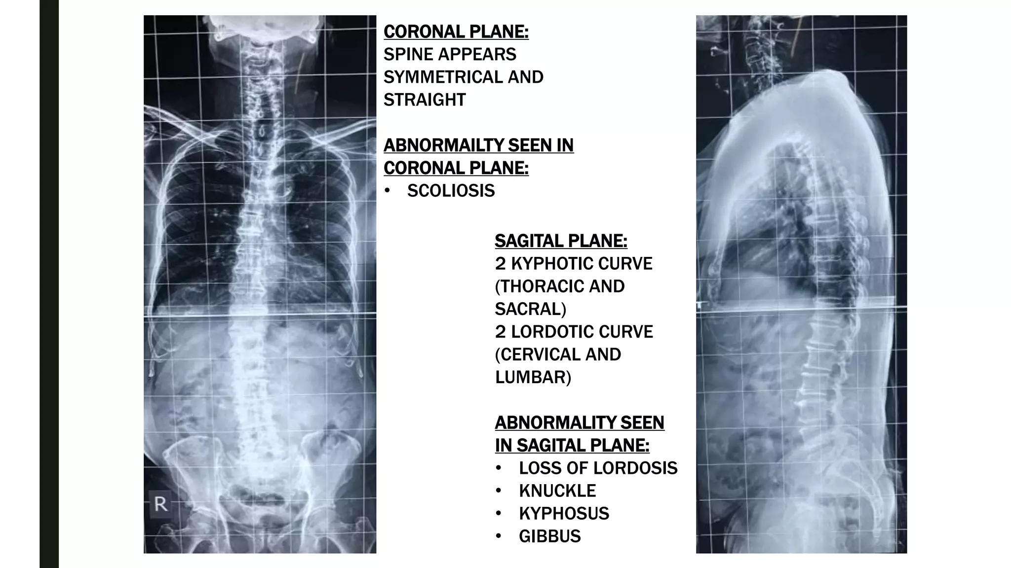 Spine anatomy and xray of spine ppt by Dr Pratik | PPTX