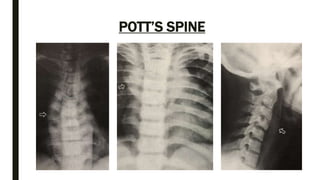Spine anatomy and xray of spine ppt by Dr Pratik | PPTX