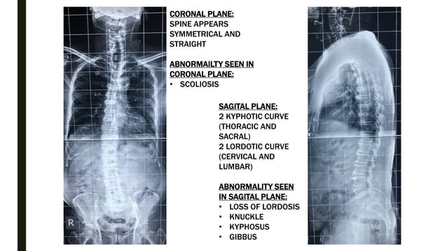 Spine anatomy and xray of spine ppt by Dr Pratik | PPTX | Death, Injury, or Military Conflict ...