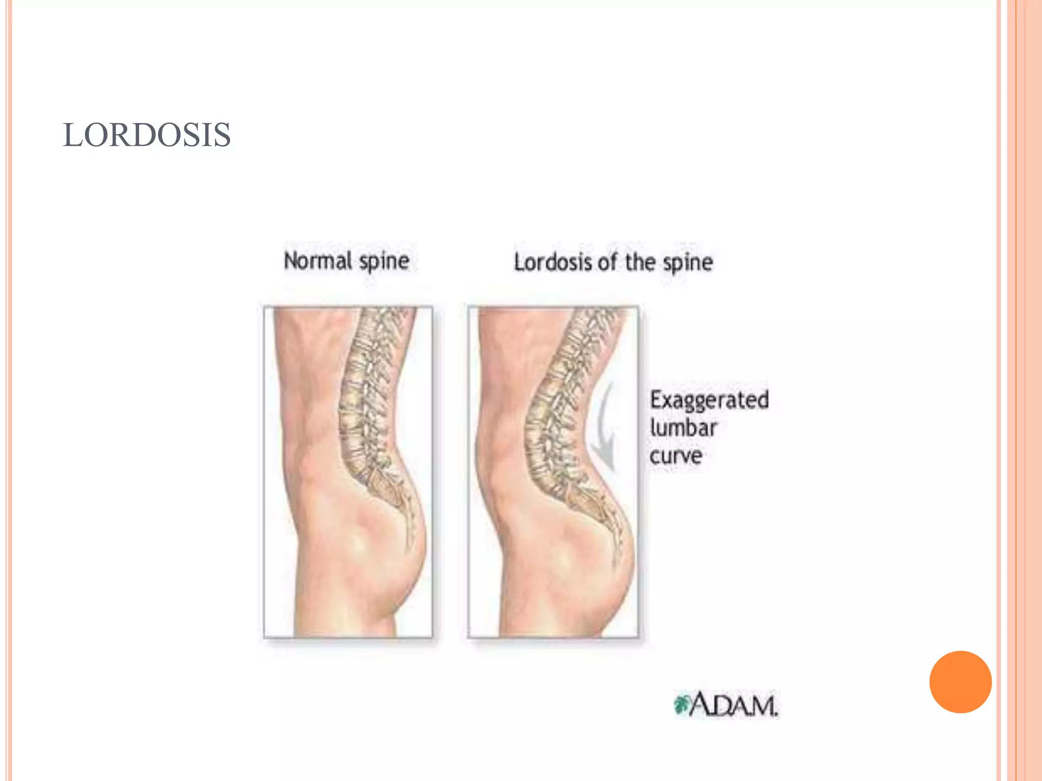 Spine curvature disorders | PPTX