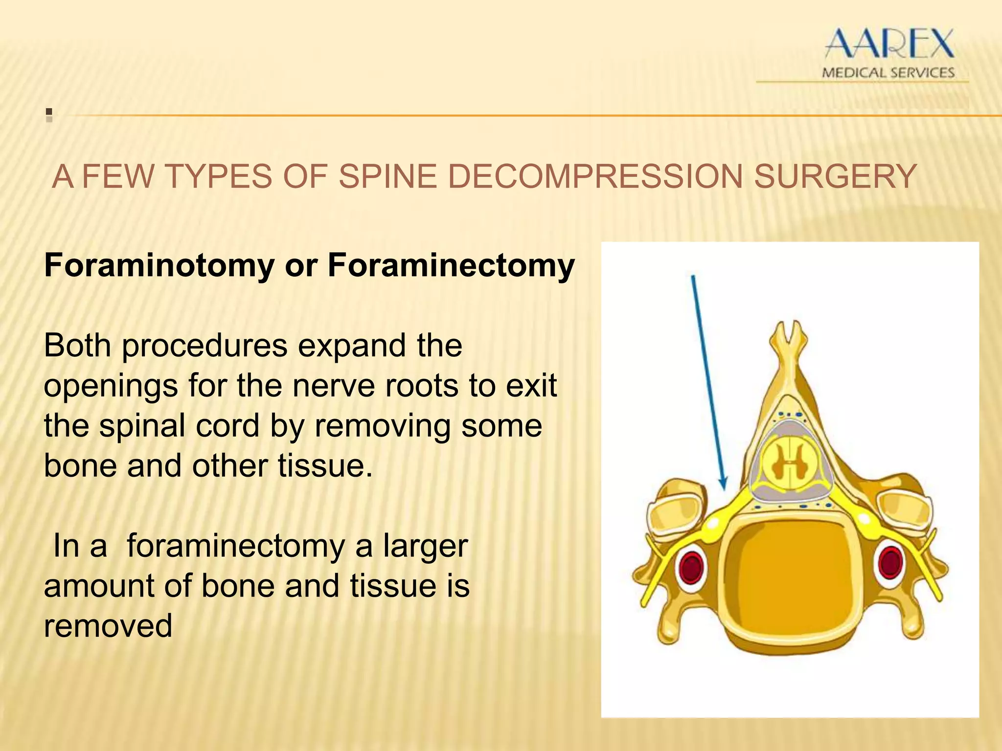 Spine Decompression Surgery | PPTX