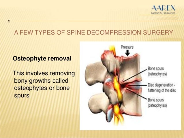 Spine Decompression Surgery