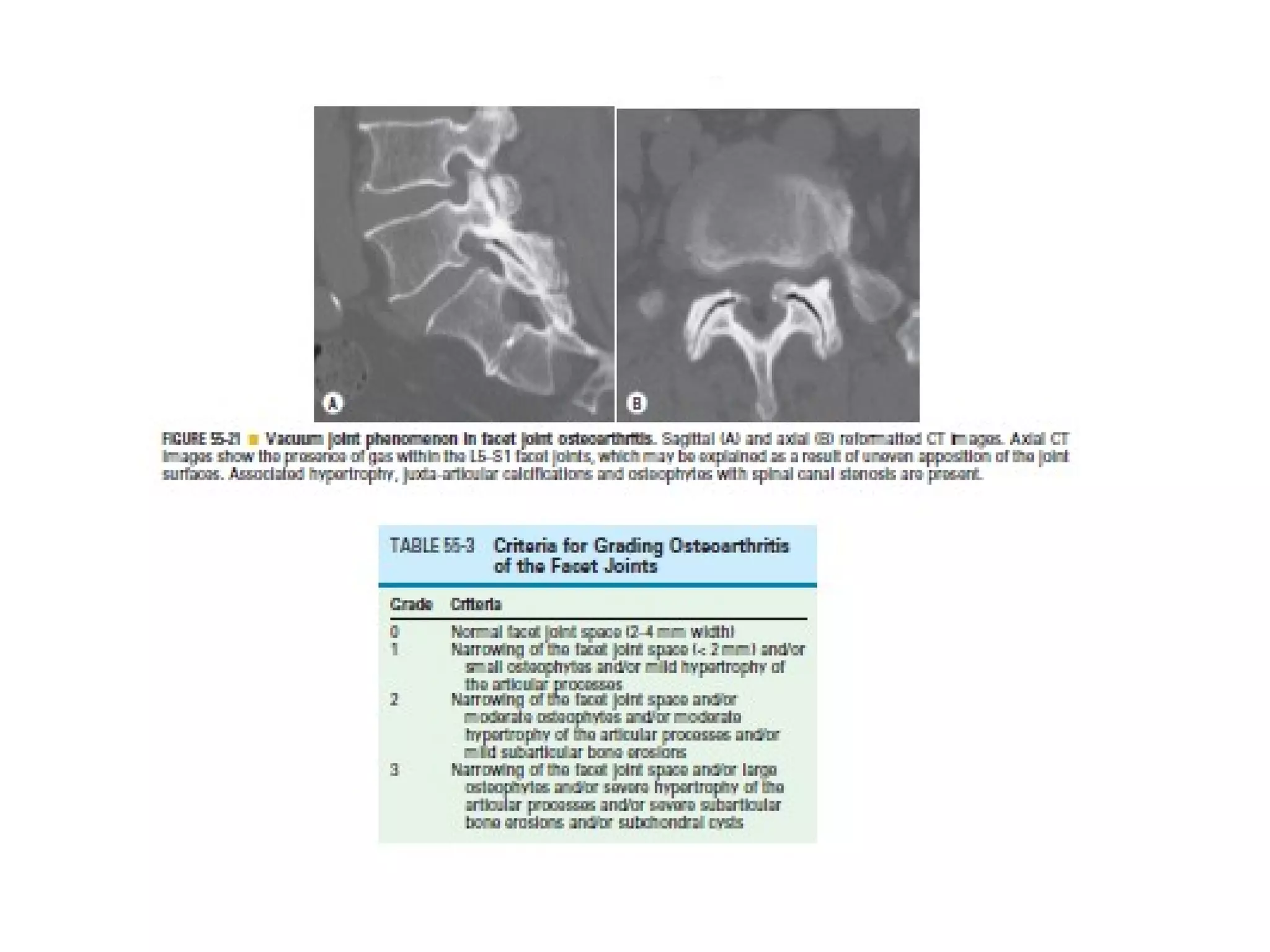 Spine degenerative disease | PPT