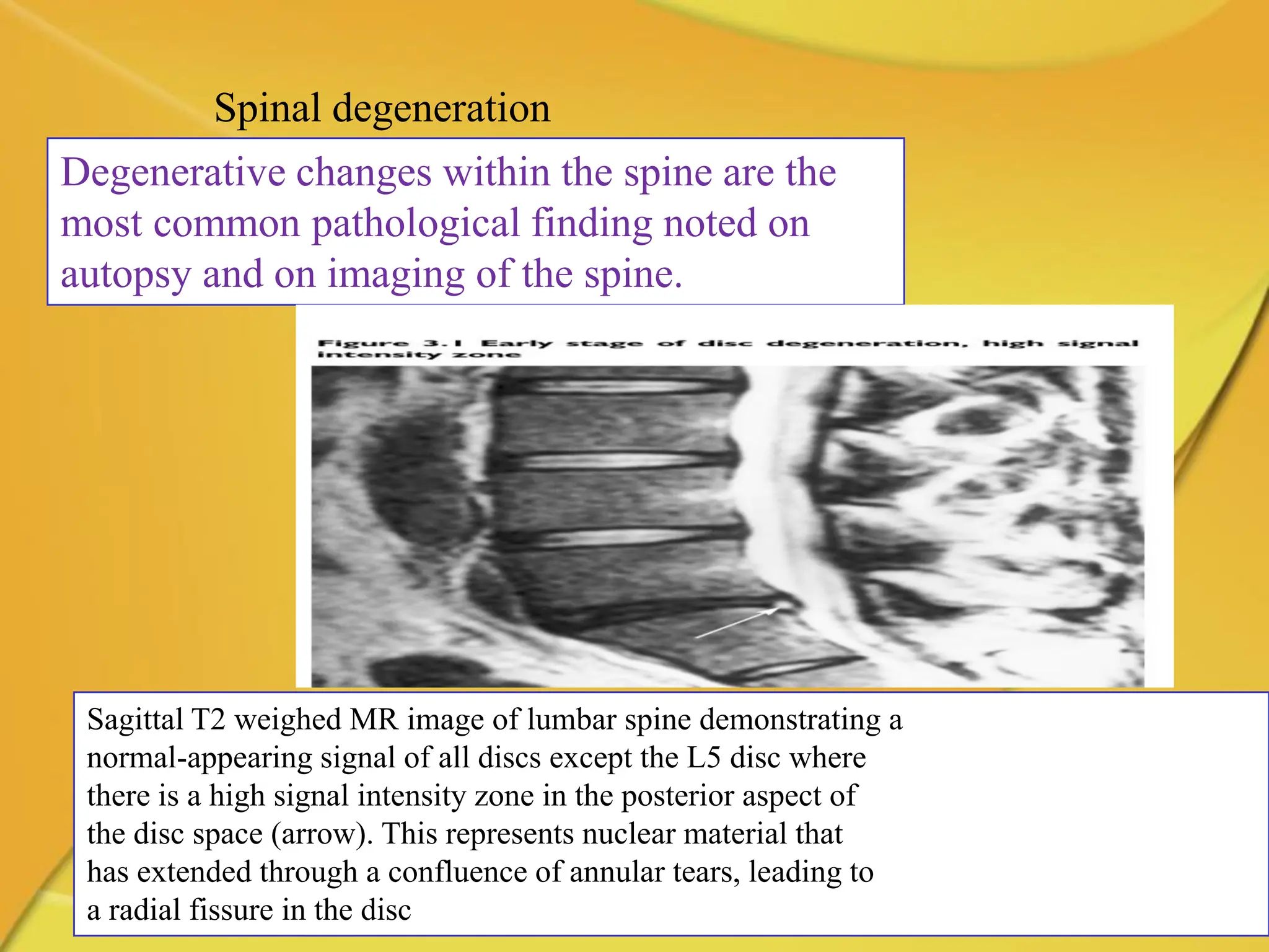 spine degeneration spinal degeneration | PPT