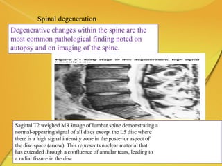 spine degeneration spinal degeneration | PDF
