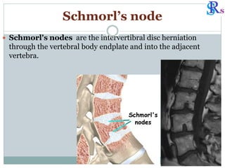 Spine disease e srs update version | PDF