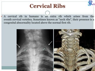 Spine disease e srs update version | PPT