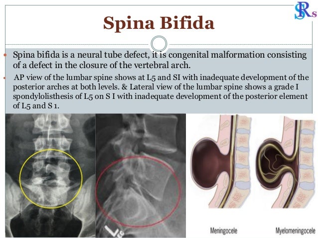 Spine disease e srs update version