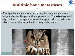 Spine disease | PDF