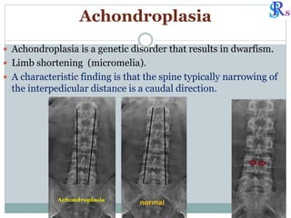 Spine disease | PDF