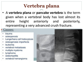 Spine disease in rg finding | PDF