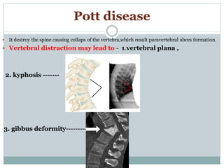 Spine disease in rg finding | PDF