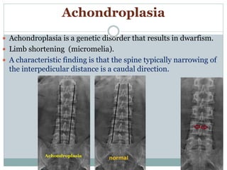 Spine disease in rg finding | PPT