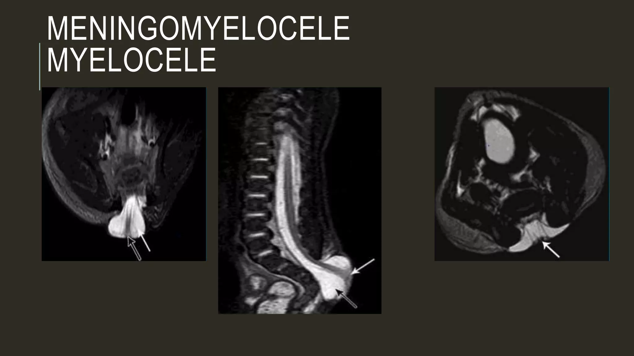 Spine dysraphism | PPTX