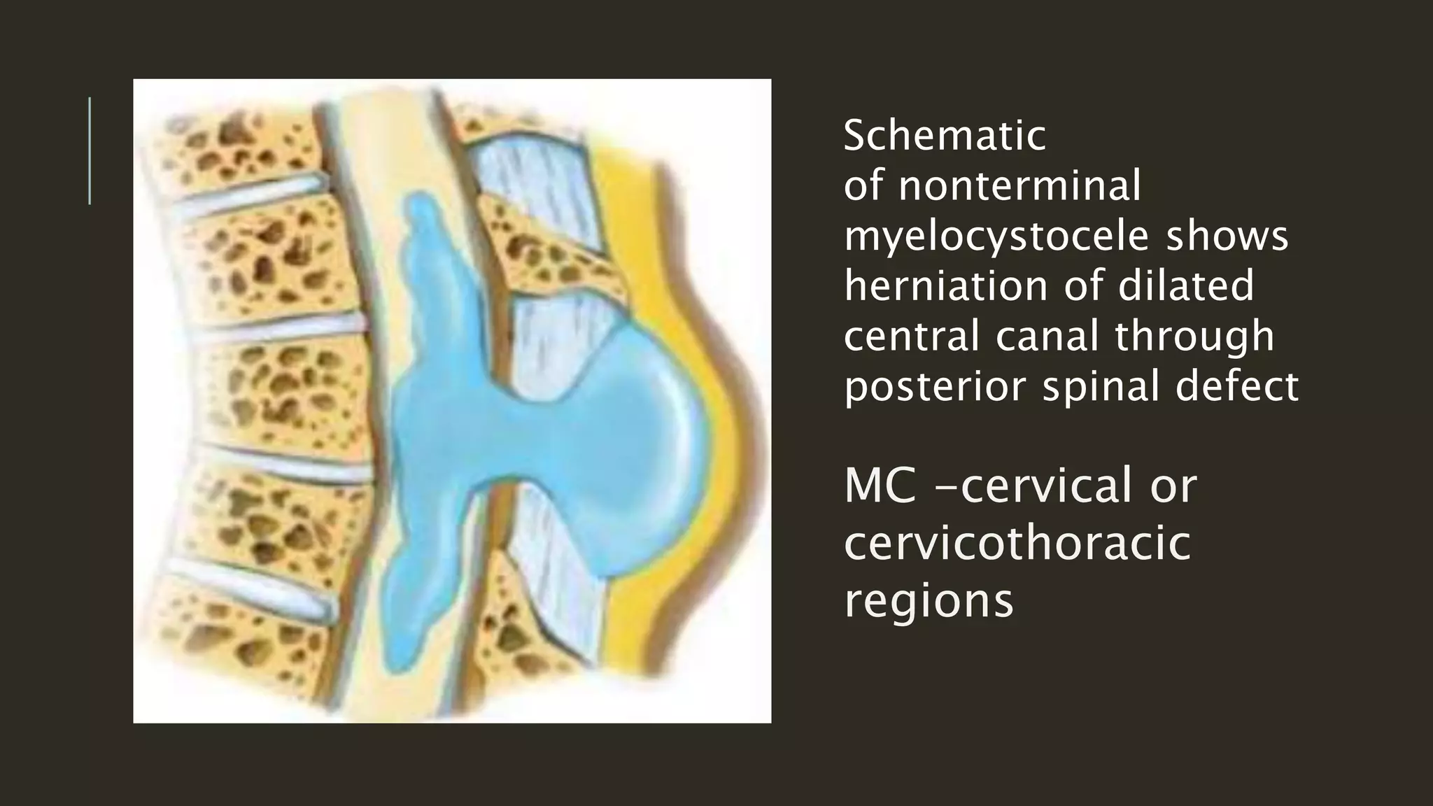 Spine dysraphism | PPTX