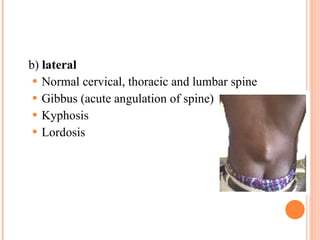 Spine Examination And Scoliosis | PPT