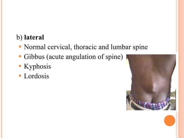 Spine Examination And Scoliosis | PPT