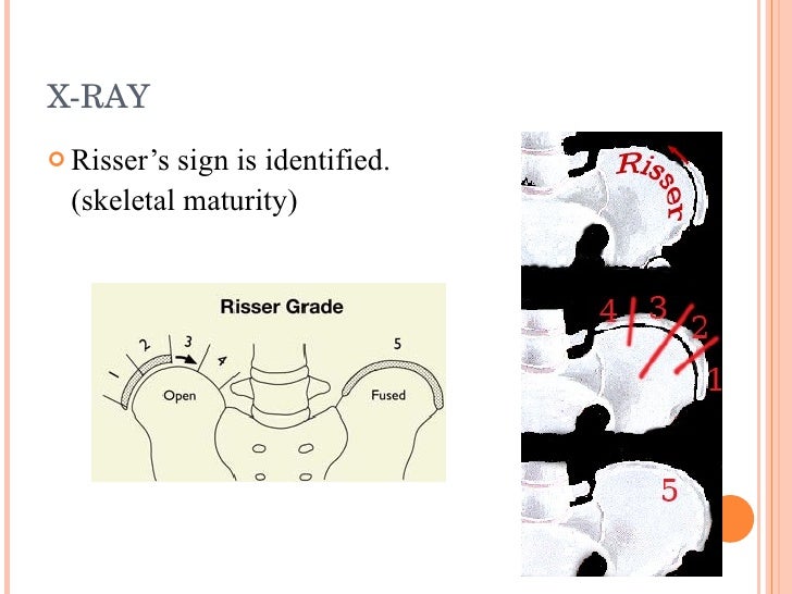 Spine Examination And Scoliosis