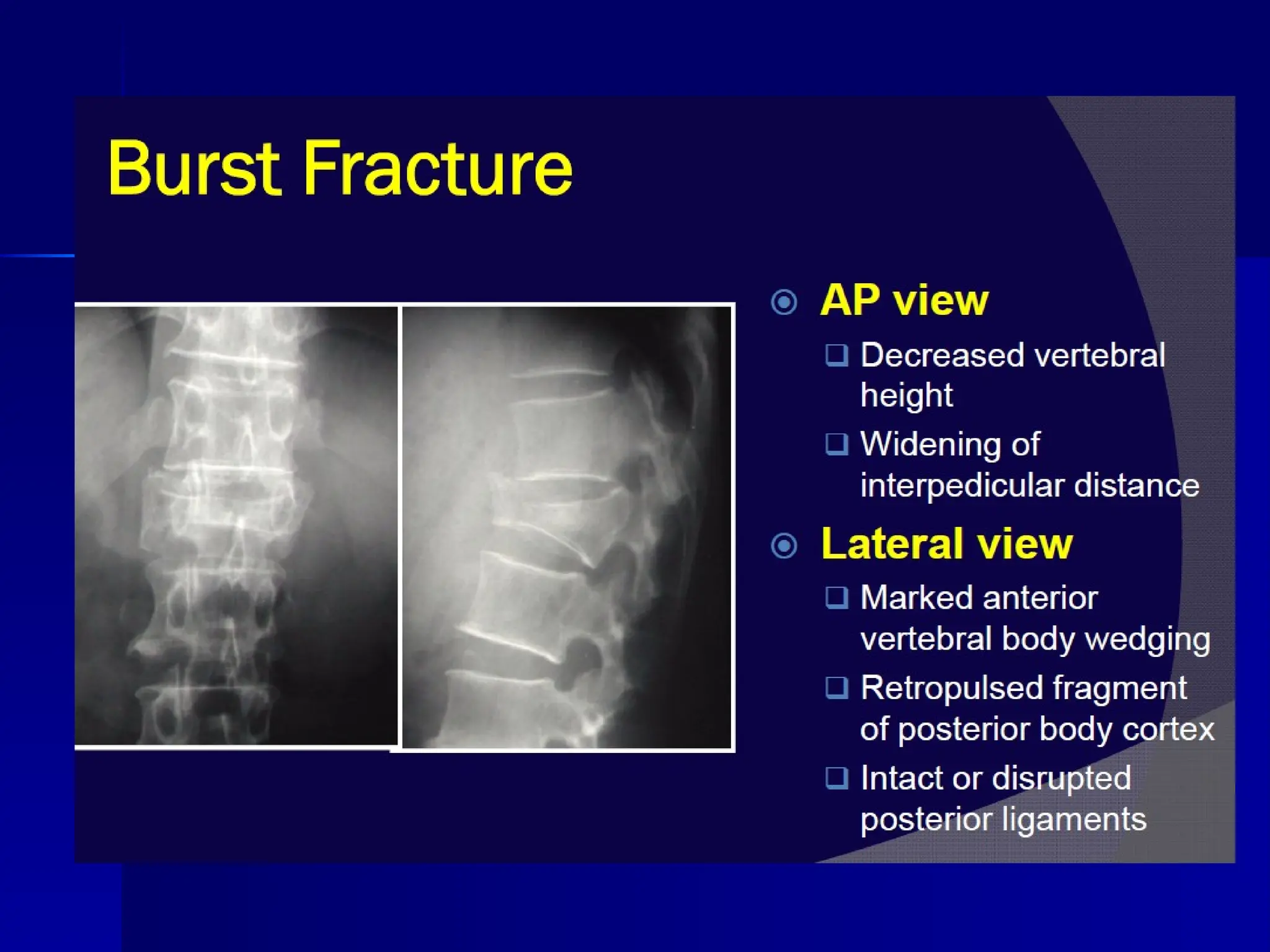 spine fracture.ppt basic orthopedic knowledge for medical student | PPT