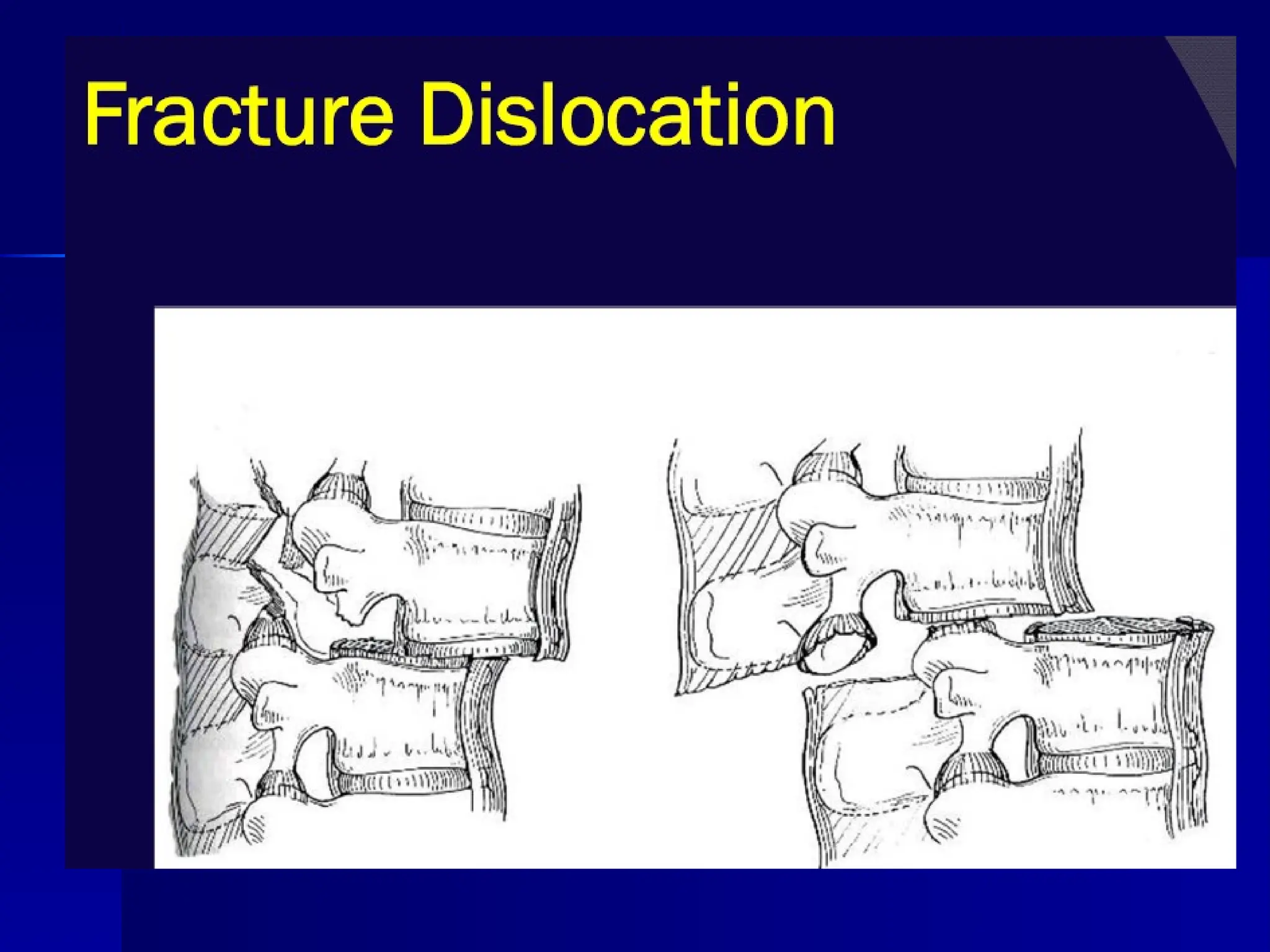 spine fracture.ppt basic orthopedic knowledge for medical student | PPT