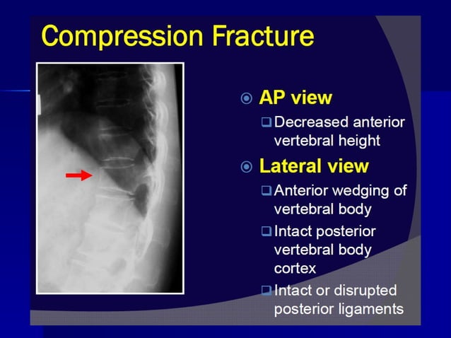 spine fracture.ppt basic orthopedic knowledge for medical student | PPT