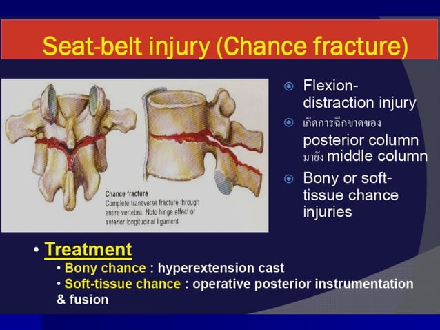 spine fracture.ppt basic orthopedic knowledge for medical student | PPT