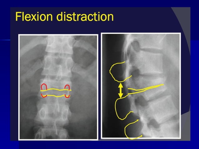 spine fracture.ppt basic orthopedic knowledge for medical student | PPT