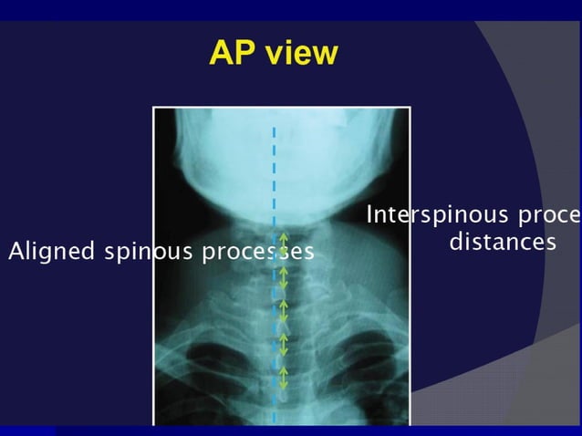 spine fracture.ppt basic orthopedic knowledge for medical student | PPT