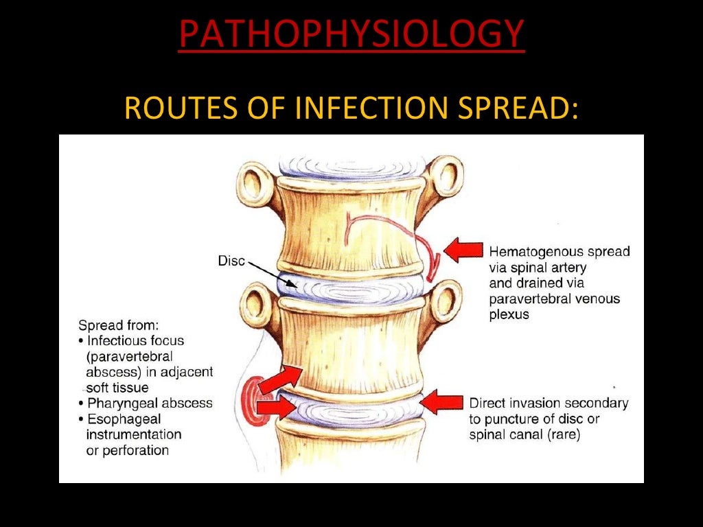 Spine infection