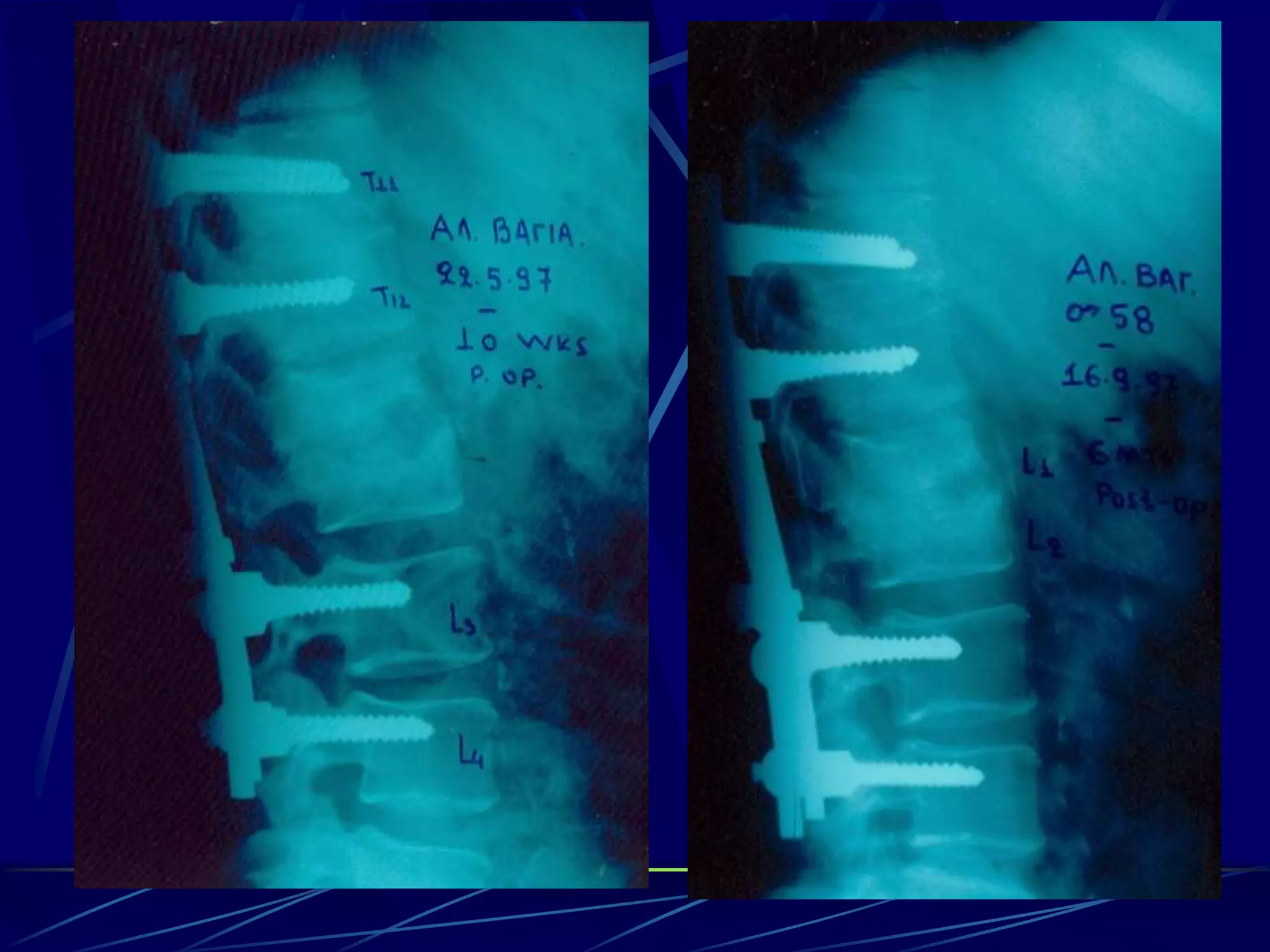 Spine infections 2009 | PPT