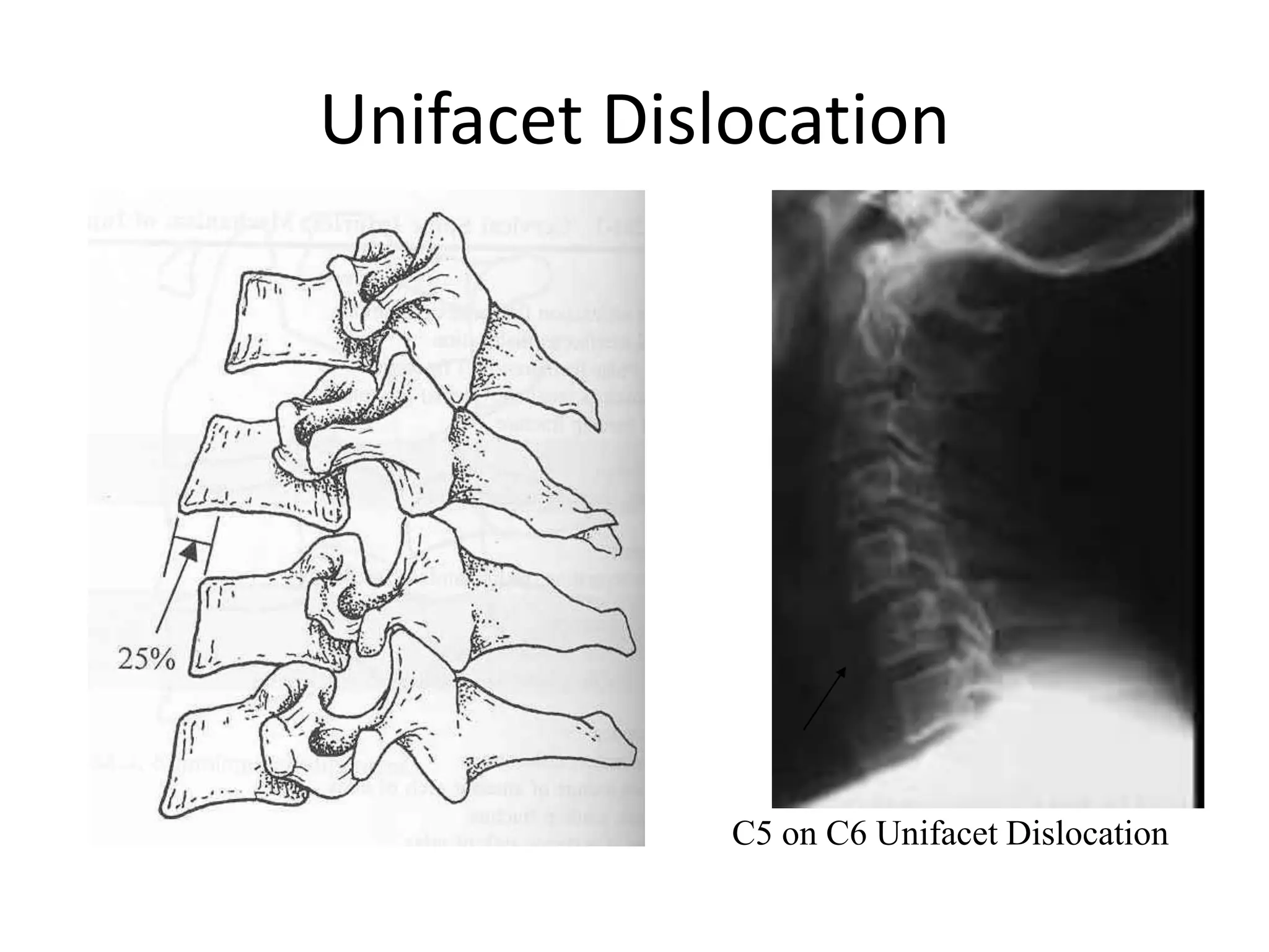 Spine injuries in our daily lifestyle.ppt