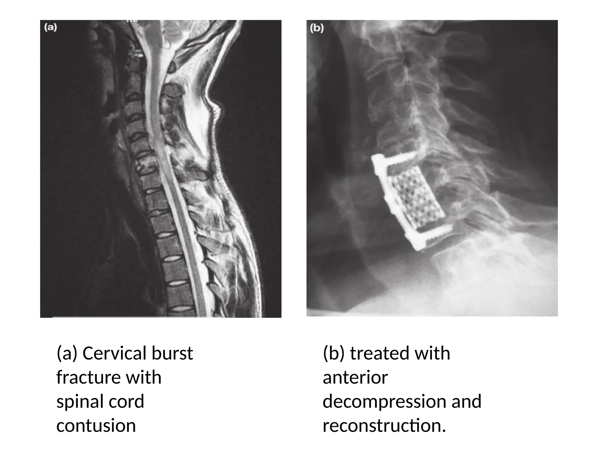 Approach to spinal injuries final .pptx