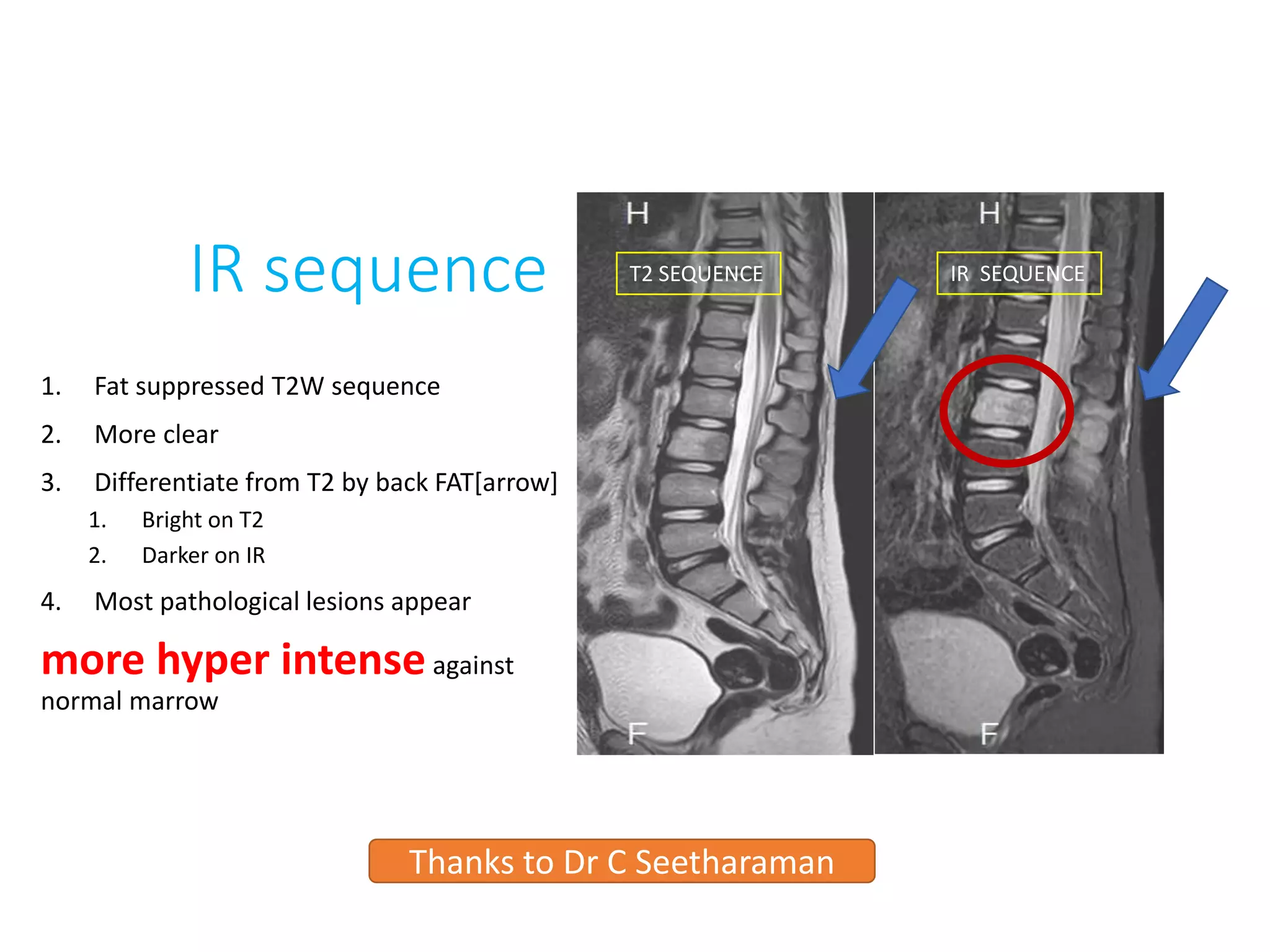 ANATOMY OF MRI SPINE | PPTX