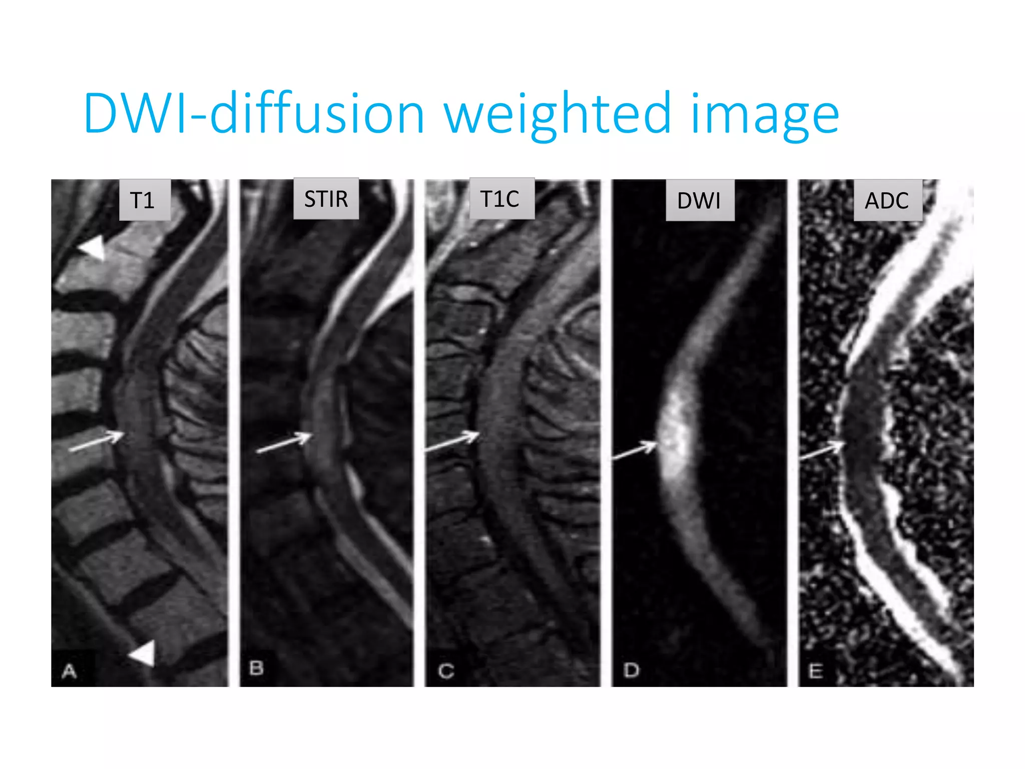 ANATOMY OF MRI SPINE | PPTX