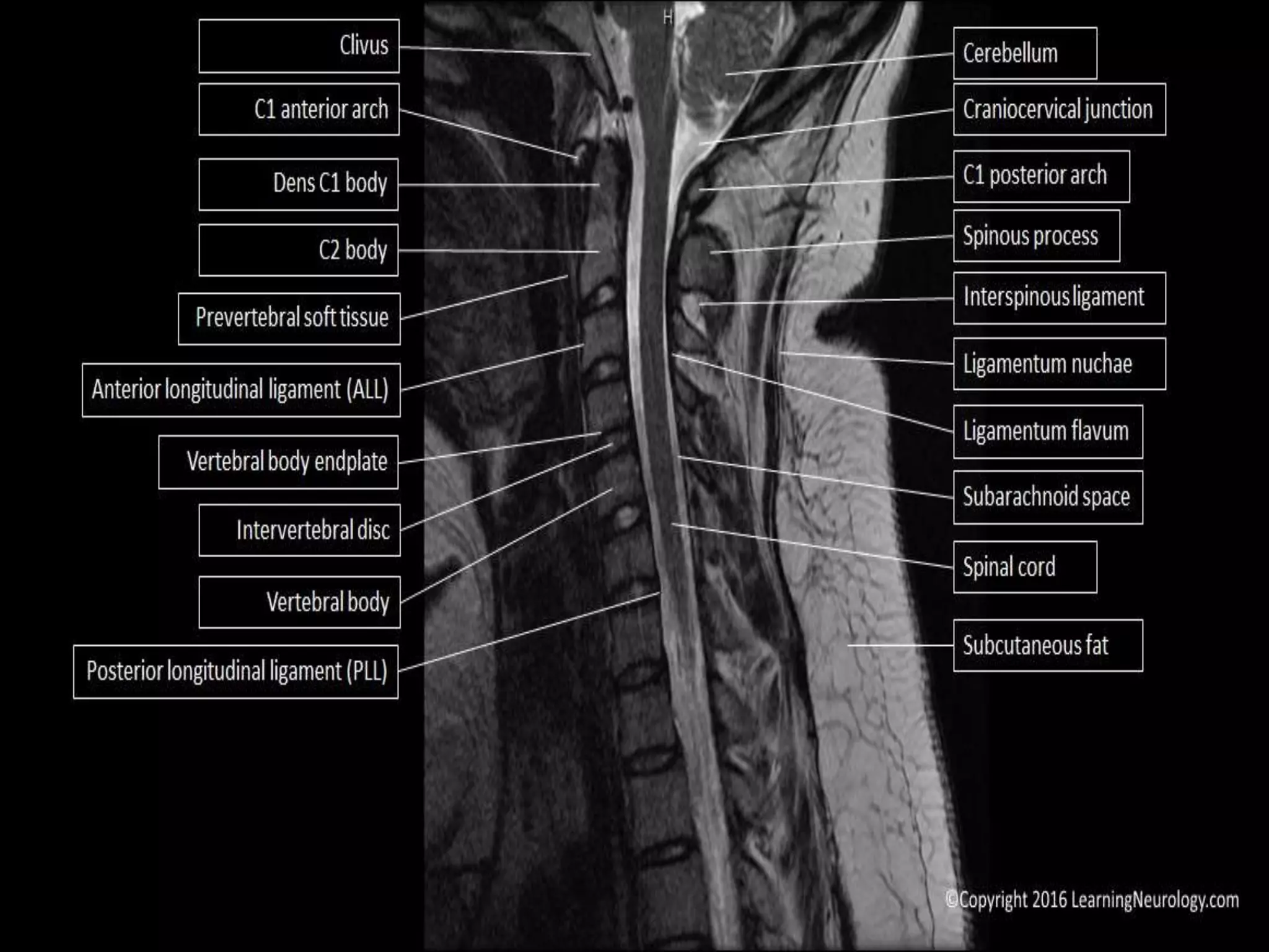 ANATOMY OF MRI SPINE | PPTX