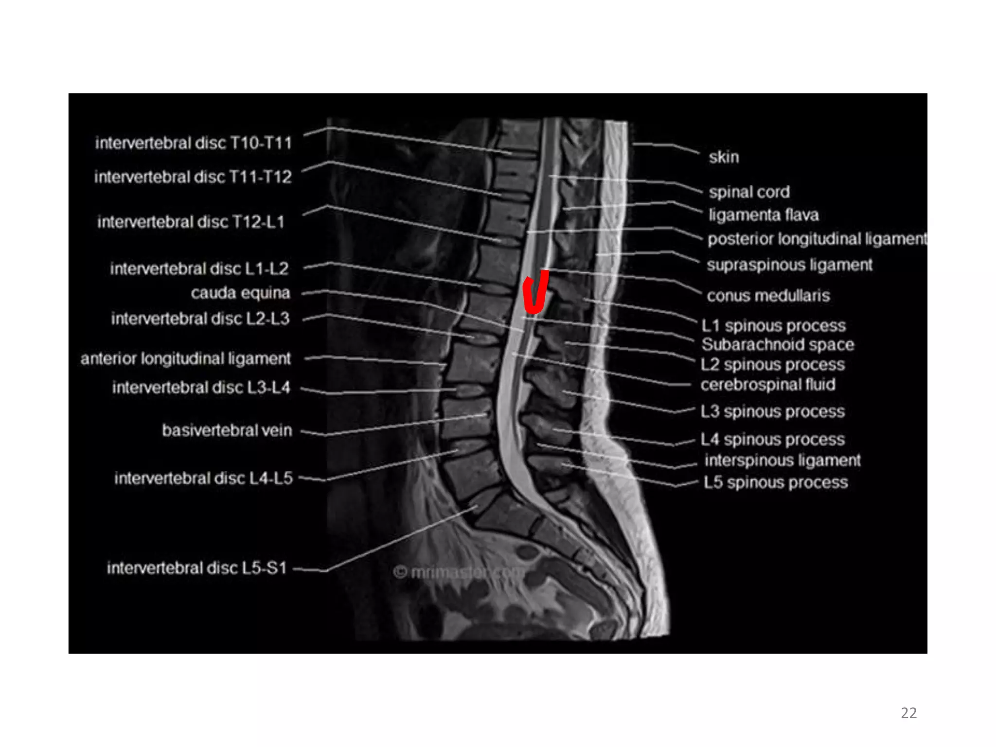 ANATOMY OF MRI SPINE | PPTX