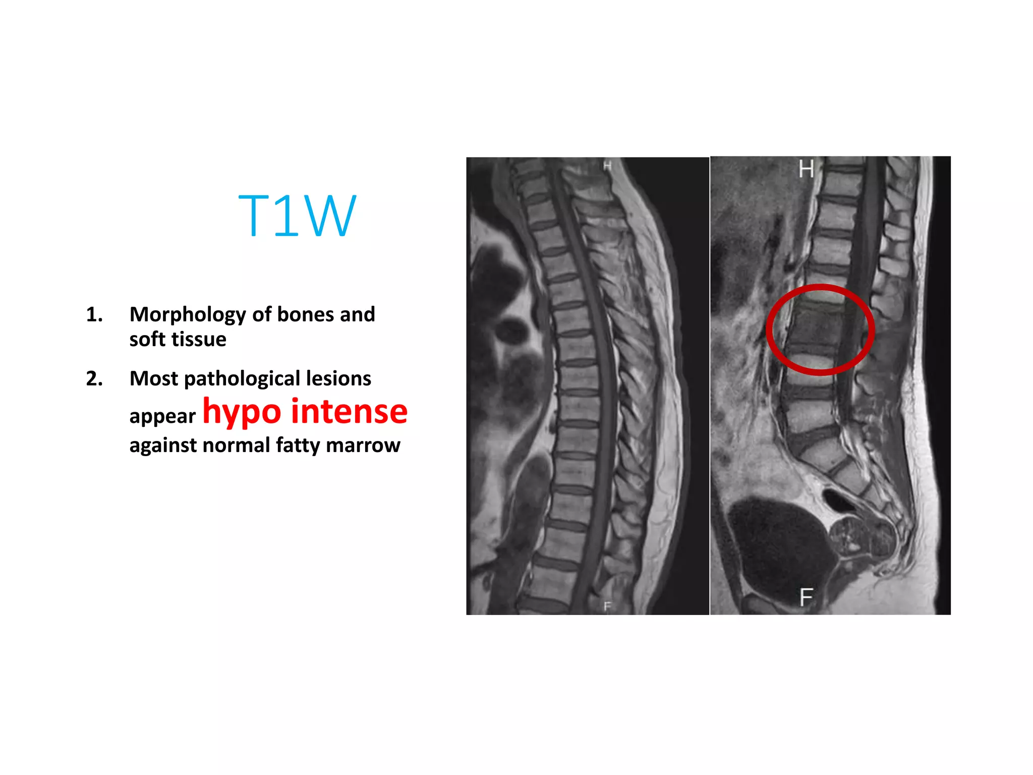 ANATOMY OF MRI SPINE | PPTX