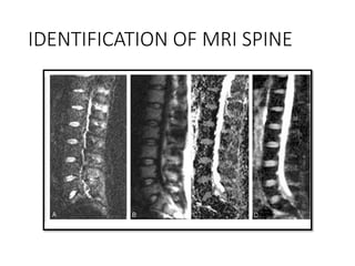 ANATOMY OF MRI SPINE | PPTX